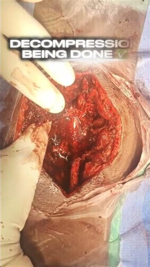 Procedure- Posterior Decompression with Fixation L4-S1