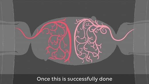 Surgeons announce conjoined twins separated at Great Ormond Street