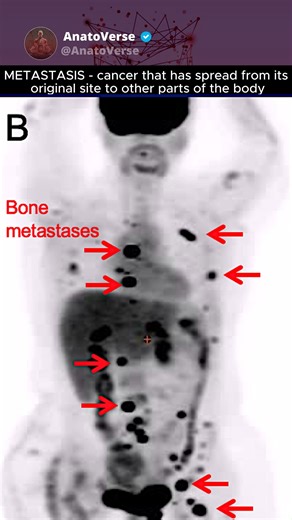 Cancer doesn’t just grow, it travels. Metastasis is when cancer cells spread to new parts of the body, making the fight tougher but never impossible. #CancerAwareness #Metastasis #FightCancer #Oncology | AnatoVerse | Facebook