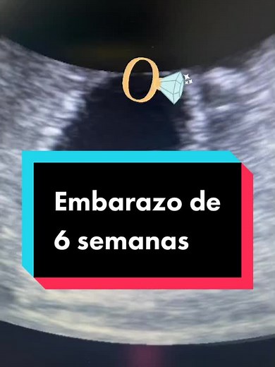 Understanding a 6-Week Pregnancy Ultrasound
