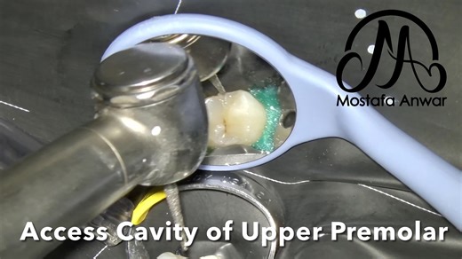Treating Buccal Gingival Recession in Upper Premolar