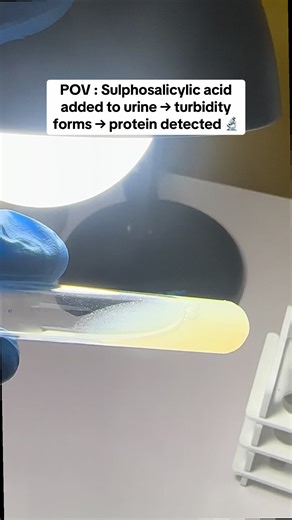 Understanding the Sulphosalicylic Acid Test for Proteinuria