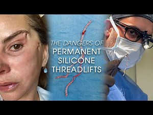 The Dangers of Permanent Silicone Threadlifts