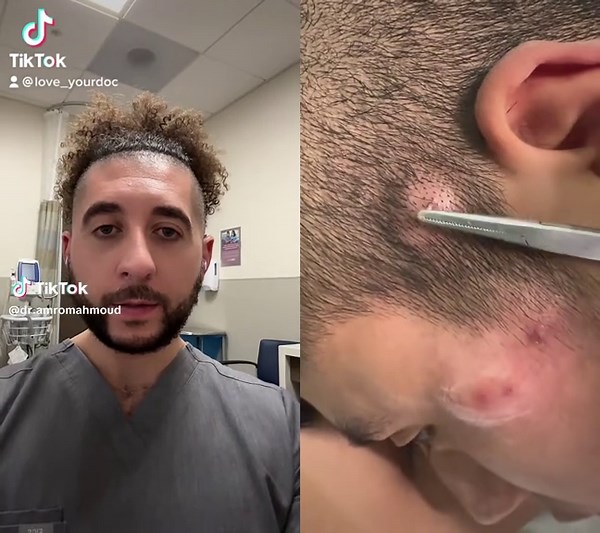 He thought it was just a bump… until THIS crawled out of her scalp 😳🪰 Turns out it was a botfly larva. Nature is wild. #DermTok #MedicalTikTok #Botfly #ScalpExtraction #DrPimplePopperVibes