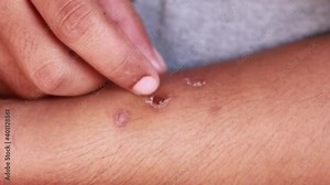 A man scratching a wound on his arm, Allergic skin lesions on the arms.