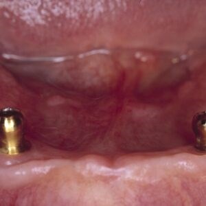 Implant Dentures (Complete) - Northland Prosthodontics - Northland Denture Specialist - Whangarei