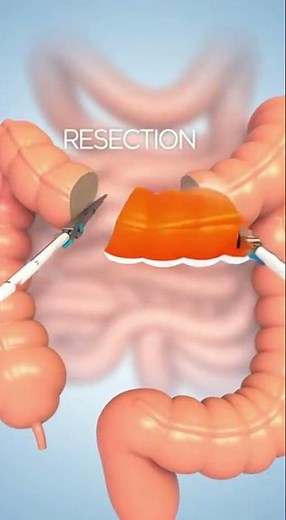 This Surgical Procedure Removes Colon Tumors #medical #facts