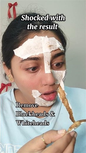 Blackheads & Whiteheads Removel Result Shocked 😱 #blackheadremoval #skincare #homeremedies #shorts