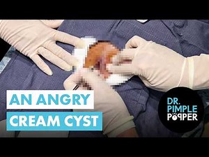 An Angry Cream Cyst