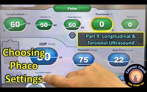 Phaco Fundamentals Part 9: Longitudinal & Torsional Ultrasound