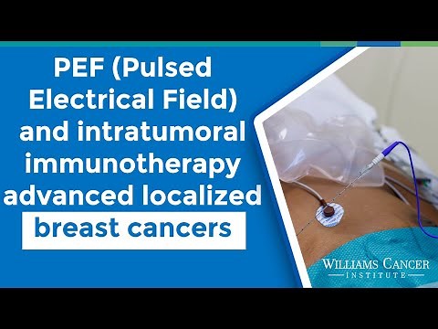 PEF (Pulsed Electrical Field) and intratumoral immunotherapy advanced localized breast cancers