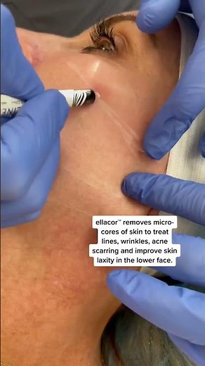 New Ellacor Micro-Coring Treatment