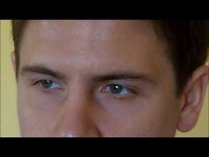 Whiplash injury: smooth pursuit neck torsion (SPNT) test (Part 2).