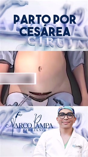 Parto por cesárea en vivo: ¿De qué se trata? - Videos de partos normales