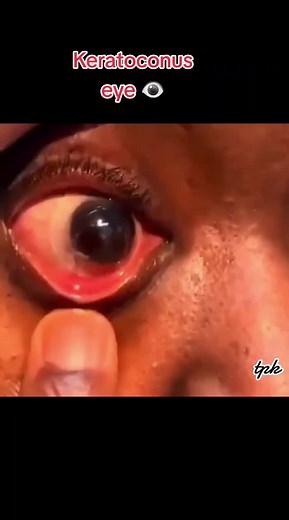 Keratoconus is an eye disease that affects the structure of the cornea, resulting in loss of vision. Keratoconus occurs in approximately one in 2,000 individuals, typically beginning in puberty and progressing into the mid-30s.