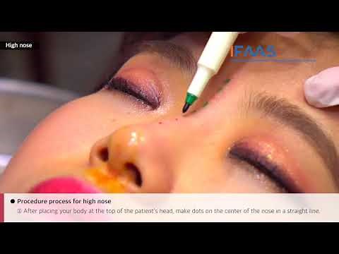 IFAAS Exclusive Training Video: Ultra V Hiko Nose Thread Lifting by Dr Han-Jin Kwon