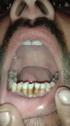 Regrow Gums around teeth naturally | Tooth Mobililty Causes| Gum Recession #shorts