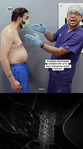 Understanding Ankylosing Spondylitis Treatment: Chiropractic Crack