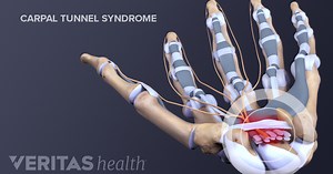 Getting the Right Diagnosis for Numb Fingers