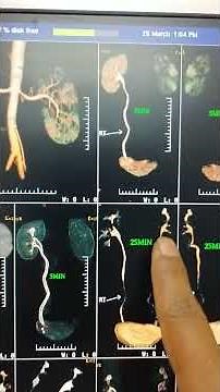CT scan of urogram 3D image,,