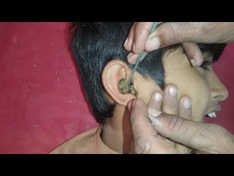 ASMR Deep Ear Cleaning | Most Relaxing Ear Sounds Ever! 👂