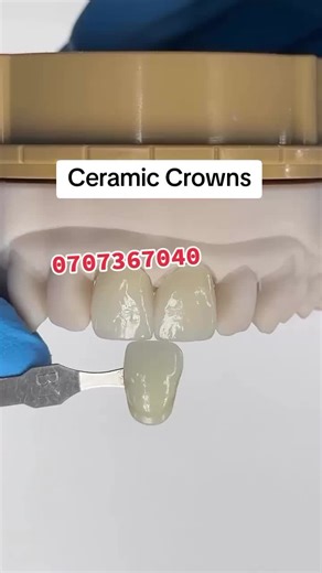 Affordable Dental Care with Ceramic Crowns