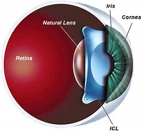 Laser Eye Surgery Price & Treatment in Malaysia | AsiaEye