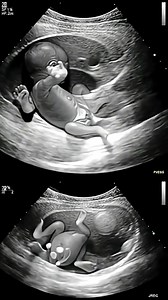 Ultrasound Pregnancy Twins Gender Identification Special interaction between the twins #shorts #friends #facebook #viral #discover | Dr. Muhammed Ziya