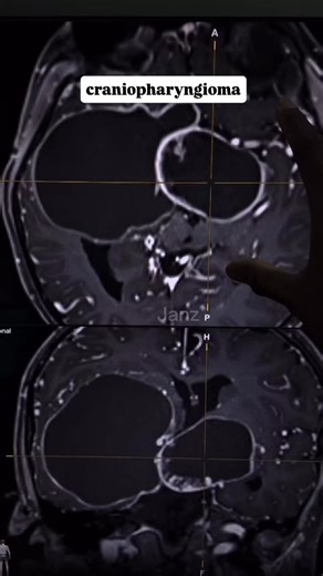 “Understanding Craniopharyngioma: This MRI reconstruction shows a rare, benign tumor located near the pituitary gland at the base of the brain. While non-cancerous, its proximity to critical structures like the optic nerves and hypothalamus requires precise surgical planning.” #mri #radiology #tumor | Sobat Radiology