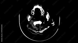 cerebral vascular malformation arteriovenous malformation, head ct scan