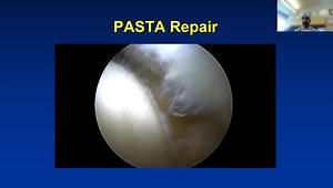 PASTA Repair: Knotless all Suture-Anchor Technique