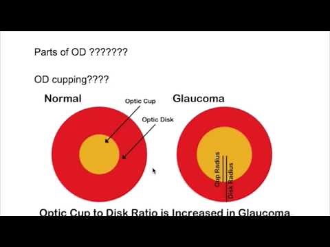 1- Papilledema/Optic disc/cup/------2- papilledema, stages, c/f, labs, https://youtu.be/qQDON7DFBwY