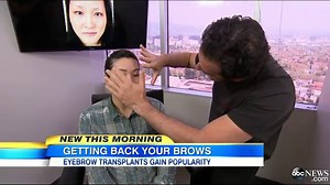 Women Turn to Eyebrow Transplants for Fuller Brows