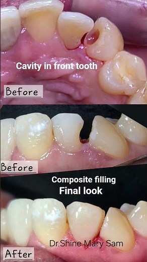 Composite filling in front tooth| natural look of front teeth cavity filling | DrShinemary