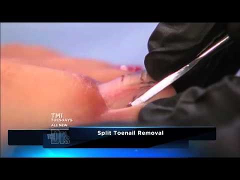 How to Remove a Split Toenail -- The Doctors