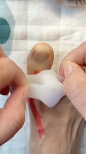 foot shape" toe separator, for bunions and overlapping toes.