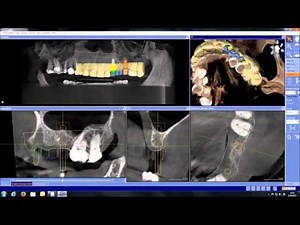inLab SW 15 - CEREC Guide 2 Workflow with GALILEOS