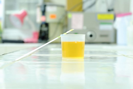 ECBU : à jeun, résultat, comment recueillir les urines ?