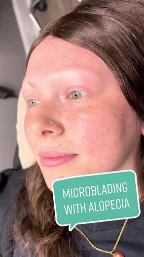 Empowering Confidence: Microblading for Alopecia