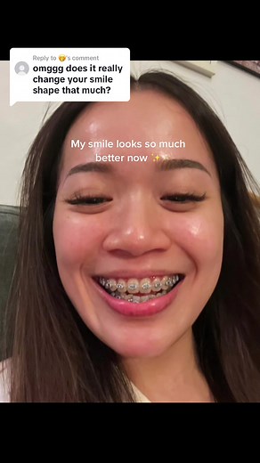 Braces Journey Transformation: How My Smile Changed Before and After Braces