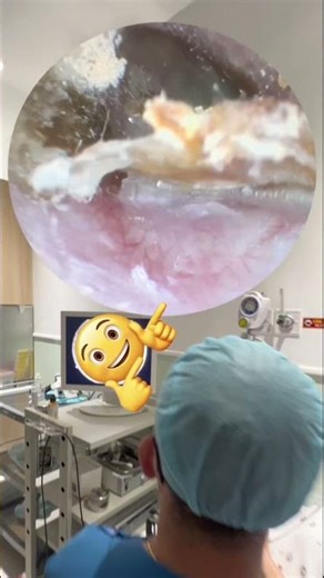 🔥 Hard Impacted Earwax Removed Safely by ENT #shorts #earwaxremoval #health