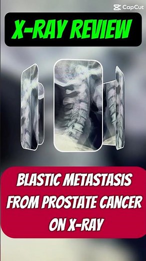 Bone Cancer on X-ray - Metastasis of Prostate Cancer