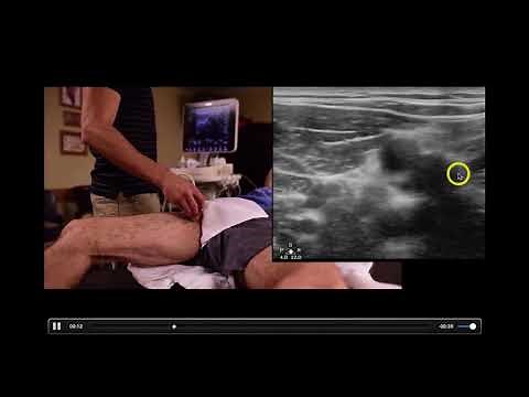 Deep Vein Thrombosis - Diagnosis with Ultrasound