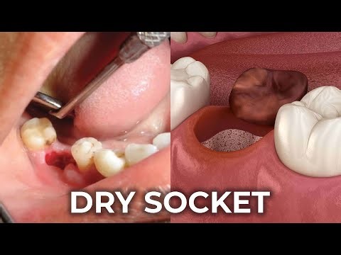 How to Treat Dry Socket After Tooth Extraction | ٹوتھ ایکسٹریکشن کے بعد ہونے والے ڈرائی ساکٹ کا علاج