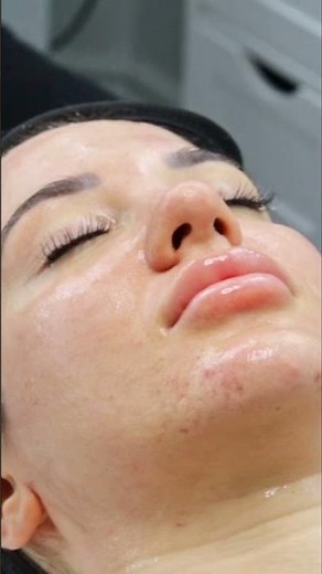 Extraction de Comédons: Le Guide Ultime Après un Peeling #shorts