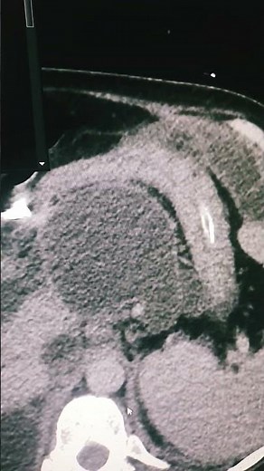 AXIOS Stent placed between stomach and peripancreatic collection ... see how the collection reduced.