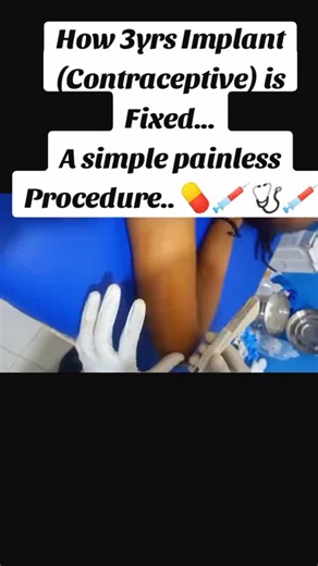 How to fix a 3yrs Implant Contraceptive. Simple procedure #contraception #implant #kitengela #kitengelatiktok #familyplanning