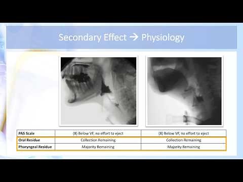 #e012 Preview: Translating MBSS Results Into Targeted Treatment Using The MBSImP™ Approach