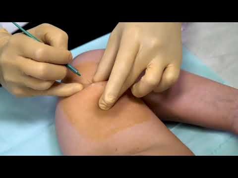 IMPLANON NXT Removal procedure video for Doctors.