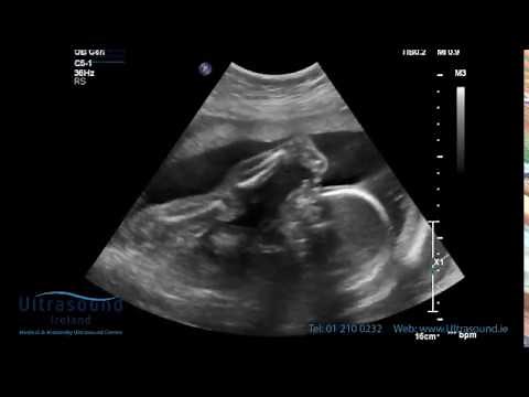 Scan of the Week: 20 Week Detailed Anomaly Scan